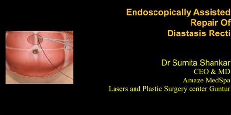Endoscopically Assisted Repair Of Diastasis Rectii By Dr Sumita Shankar