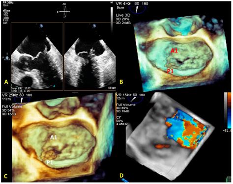 Mv Endocarditis In A Patient With Barlow Disease A X Plane Modality