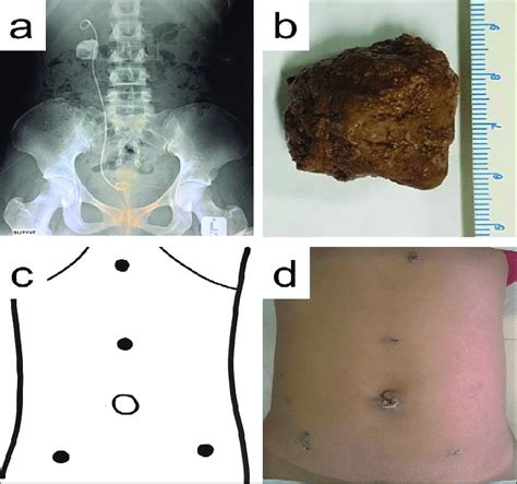 A Plain Film Radiograph Showing The Large Pelvic Calculus In Right Download Scientific Diagram
