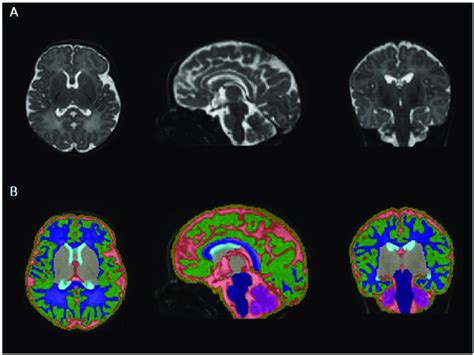 Volumetric Segmentation Of The Neonatal Brain A Reconstructed T2
