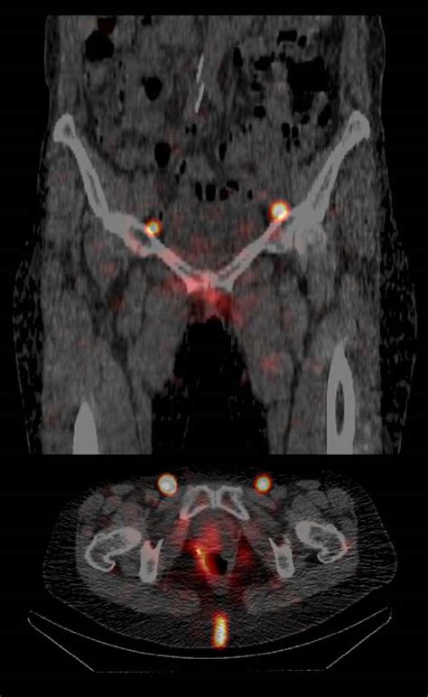 Single Photon Emission Computed Tomography Combined With Conventional Download Scientific