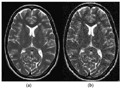 diagnostics free full text grade classification of tumors from