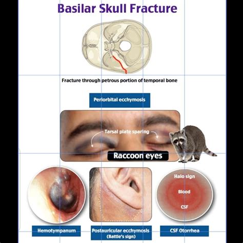 Base Of The Skull Fracture