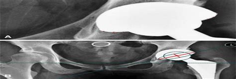 Reliability And Validity Of Measuring Acetabular Component O Clinical Orthopaedics And
