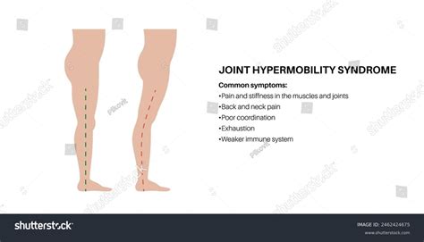 Joint Hypermobility Syndrome Hypermobility Spectrum Disorder Stock