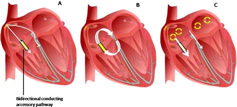 Management Of Cardiac Conduction Abnormalities And Arrhythmia In