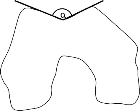 Sulcus Angle The Sulcus Angle Is The Angle Between The Medial And