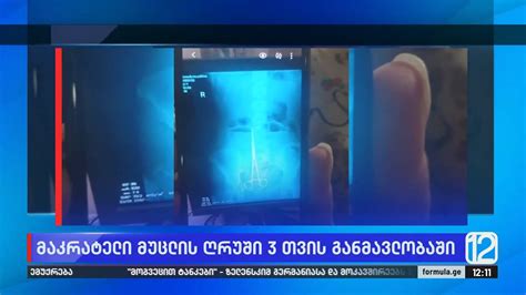 ოპერაციის დროს 22 წლის გოგოს მუცლის ღრუში მაკრატელი ჩაუტოვეს Youtube