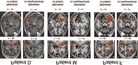 Ventral Occipito Temporal Activations In Patients The Left Column Download Scientific Diagram