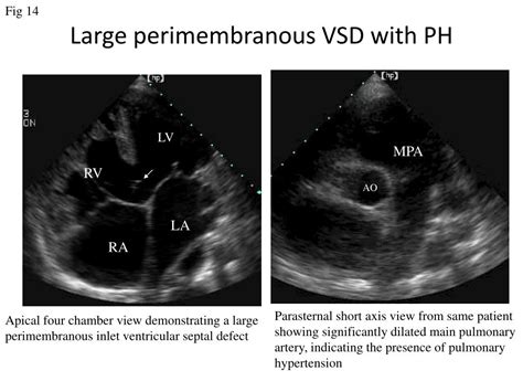 Ppt Ventricular Septal Defects Powerpoint Presentation Free Download Id 1817608