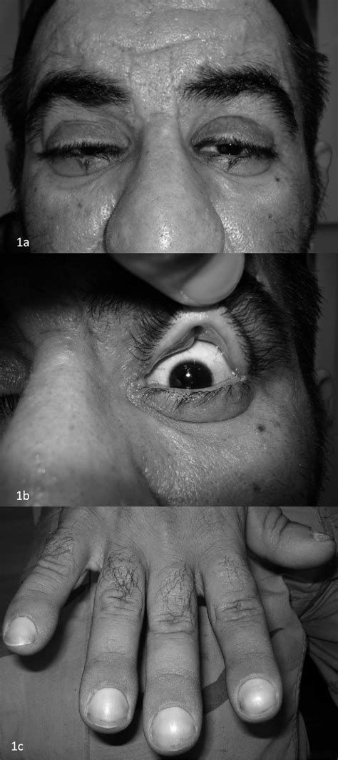 A Year Old Male With Thickened Oily Facial Skin And Prominent Download Scientific