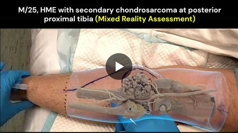 Surgical Planning With Mr And Holograms Kc Wong Posted On The Topic Linkedin