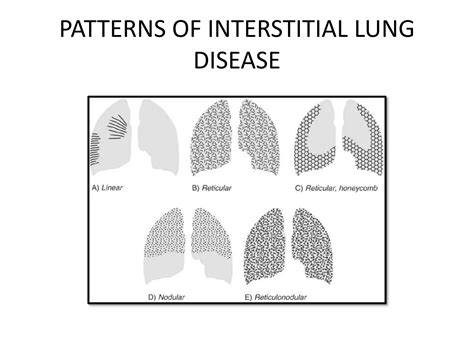 interstitial lung diseases | PPTX
