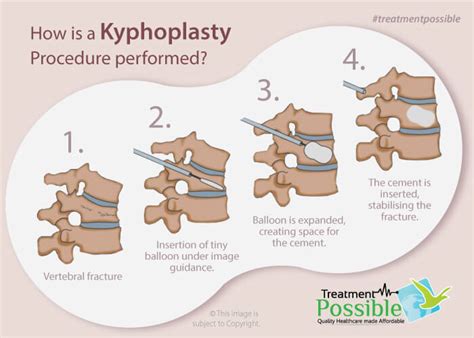 Kyphoplasty Considerations And Alternatives Advanced Procedures Dr