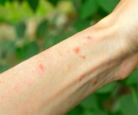How To Identify Poison Ivy To Prevent A Painful Rash Gardening Know How