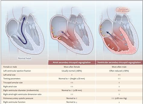 Cardioteca 🆕📌 Insuficiencia Tricúspide Anatomía