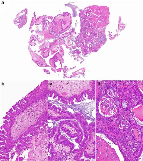 Morphologic Features Of Case 1 A The Tumor Shows A Polypoid