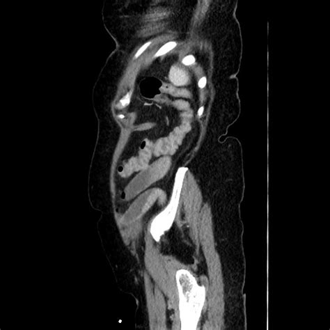 File Closed Loop Small Bowel Obstruction Due To Adhesive Band With