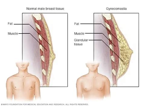What Makes Breasts Grow In Men And How To Deal With It Healthy Food