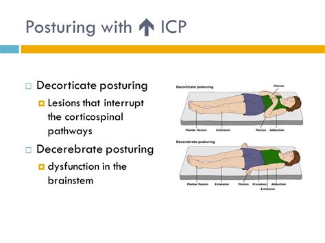 Fencing Position Vs Decorticate Posturing At Joseph Becher Blog