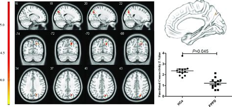 Decreased Functional Connectivity In Right Precuneus Within Posterior Download Scientific