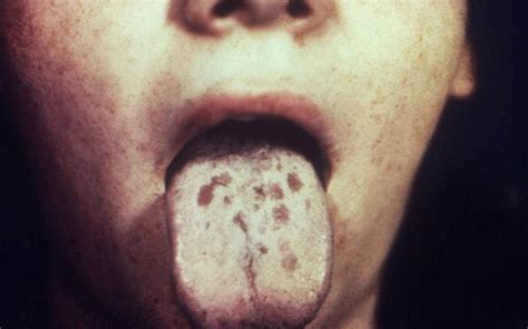 Spike In Syphilis Cases Practising Safe Sex And Testing Crucial