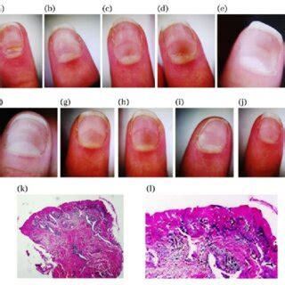 Manifestations Of Ischemia And Necrosis In The Fingers That Appeared