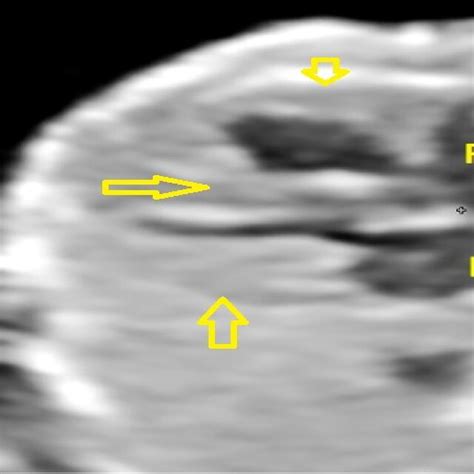 Subcostal Four Chamber View In Fetal Echocardiography Shows Download Scientific Diagram