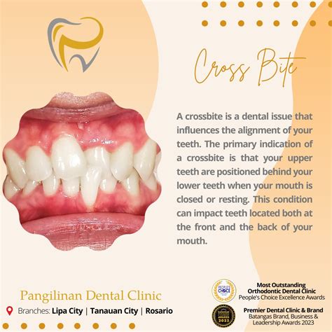 Pangilinan A Crossbite Is A Dental Issue That Influences The