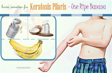 22 Best Home Remedies For Keratosis Pilaris On Arms Back And Legs