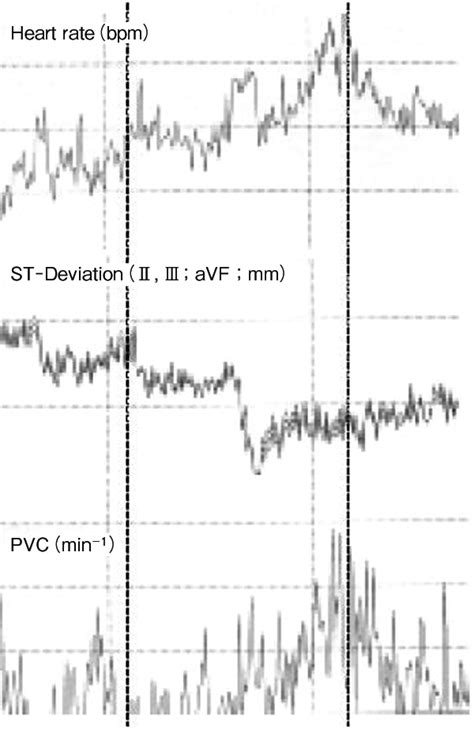 Continuous Recordings Of Heart Rate Top Stsegment Deviation Middle