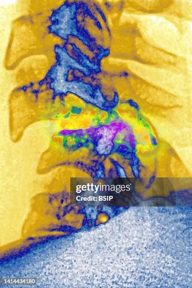 Dislocation Of The Cervical Vertebrae With Spinal Trauma Between