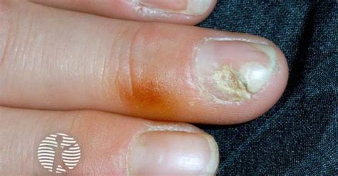 Psoriatic Nail Dystrophy Image