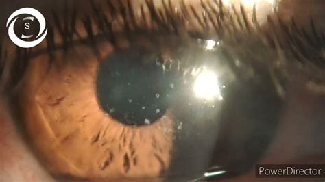 Adenoviral Punctate Keratitis Youtube