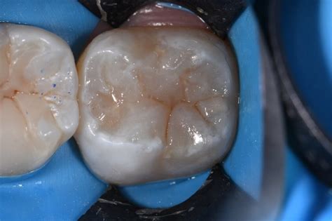 Shallow Secondary Caries Under Molar Hypomineralization