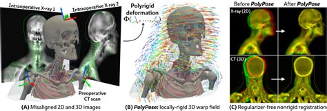 论文评述 Polypose Localizing Deformable Anatomy In 3d From Sparse 2d X Ray Images Using Polyrigid