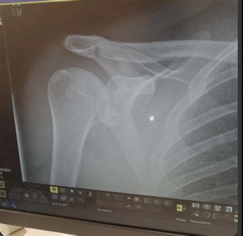 Ive Not Actually Been Told Whats Going On R Xrays