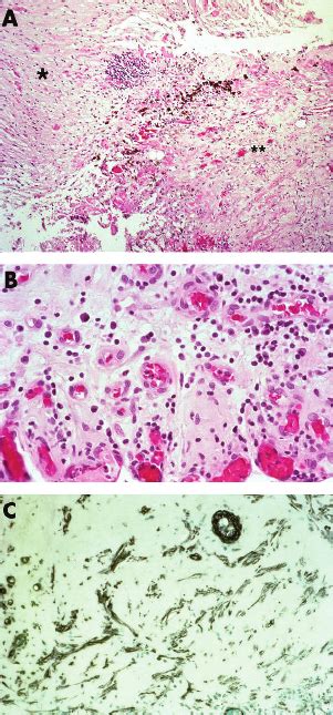 Microphotographs Showing The Subretinal Mass That Is Composed Of A