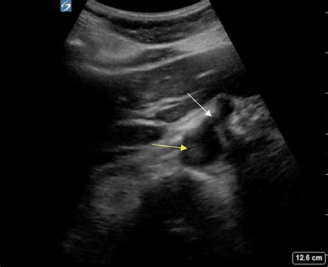 Role Of Pocus In Assessing An Acute Aortic Thrombus Pocus Journal
