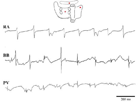 Intra Individual Variation In Electrogram Morphology Typical Examples Download Scientific