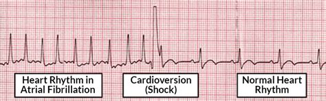 V Fib Rhythm Clipart 10 Free Cliparts Download Images On Clipground 2025