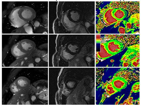 A Case Of Fabry Disease With Mild Concentric Hypertrophy And Low T1