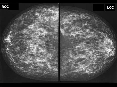 Atlas Of Breast Cancer Early Detection