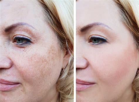 Hyperpigmentation Laser Treatment Book An Appointment Today Skiin