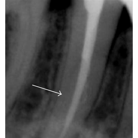A Mandibular Premolar With An Apical Third Bifurcation B Working