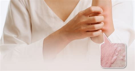 Chronic Urticaria Diagnosis Package Skymed Asia Services