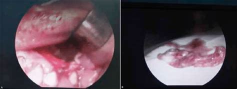 A B Intraoperative View Download Scientific Diagram