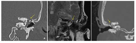 Non Absorbable Synthetic Material For Middle Fossa Repair Using A Combined Transmastoid Middle
