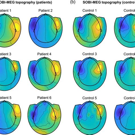 Second‐order Blind Identification Sobi Magneto Encephalographic Meg