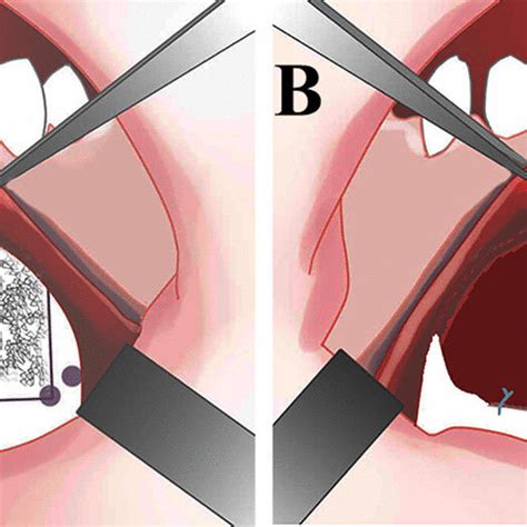 Schematic Diagram Of The Periosteum Covered Periodontally Accelerated